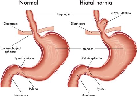 Hiatal Hernia Surgery North Carolina Specialty Hospital