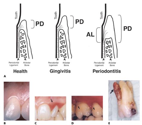 Periodontal Disease And Emphasis On P Gingivalis Flashcards Quizlet