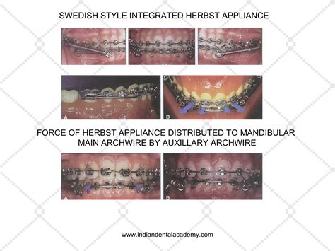 Fixed Functional Appliances Ppt Dental Health Diseases And Conditions