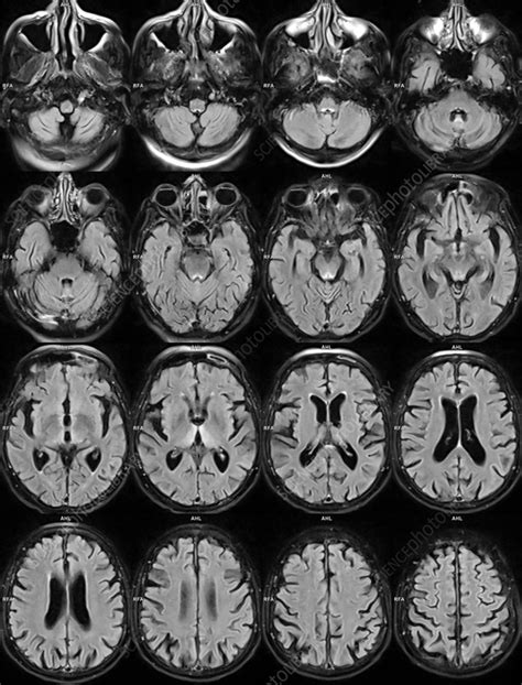 Brain Mri Scans Stock Image C062 3677 Science Photo Library