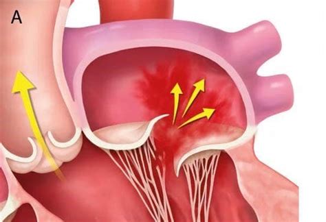 Comprendre Linsuffisance Mitrale Causes Conséquences Et Traitements