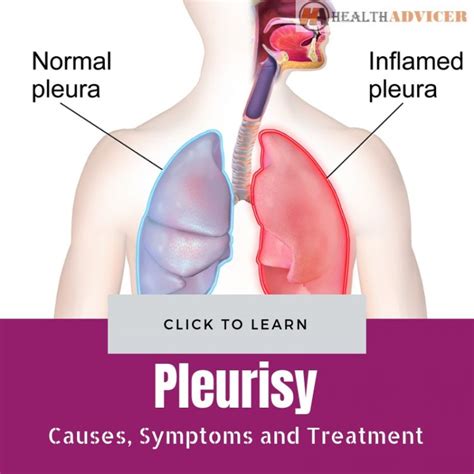 Pleurisy Causes Picture Symptoms And Treatment