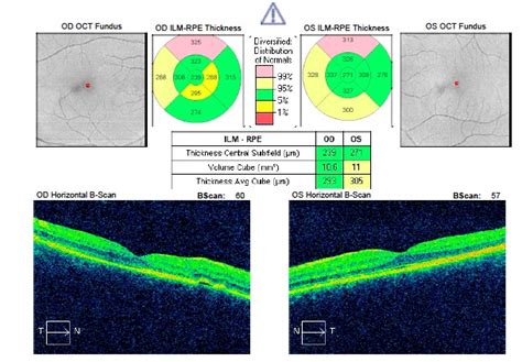 Comparison Of Crt In Resolved Acute Cscr Of The Right Eye With Healthy Download Scientific