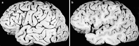 Neuroanatomy Radiology Key