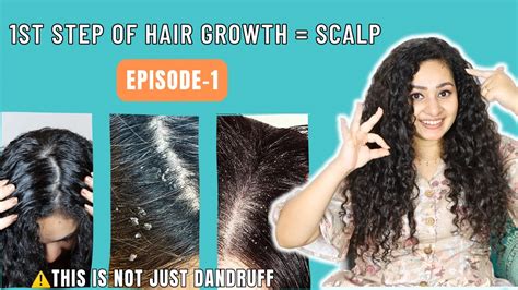 How To Identify Scalp Types Scalp Problems And Remedy Dry Dandruff Oily Scalp Care Series Ep