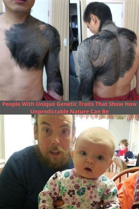 People With Unique Genetic Traits That Show How Unpredictable Nature