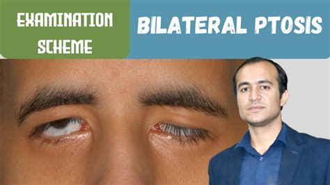 Bilateral Ptosis Examination Complete Clinical Assessment Guide Youtube