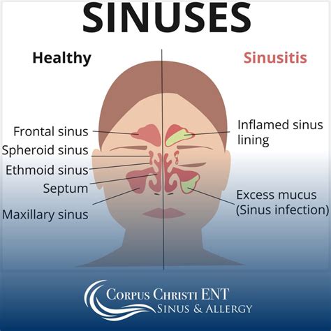 Chronic Sinus Infections When To Treat Sinusitis Corpus Christi Tx