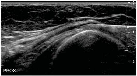 Pes Anserine Bursa Injection Wikism Sports Medicine Wiki