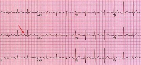 Left Atrial Enlargement Left Chart