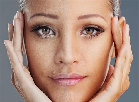 Non Cancerous Lesions Skin Benign Growth On Skin Rtwskin