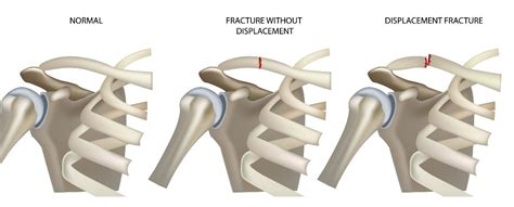 Clavicle Fracture Broken Collarbone Symptoms Diagnosis Treatment