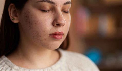 White Color Patches On Skin Types Causes And More