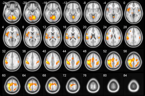 Brain Activation During Sequential Finger Tapping Task Positive Effect