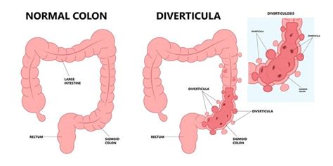 What Is The Difference Between Diverticular Disease And Intestinal