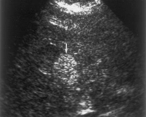 Hepatic Adenomas Imaging And Pathologic Findingsradiographics