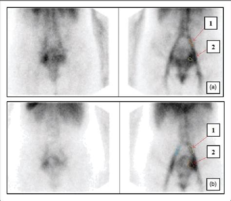 Figure From Compression Treatment Of Pelvic Congestion Syndrome Semantic Scholar