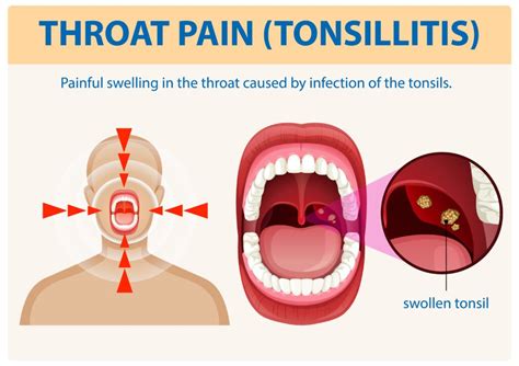 Tonsillectomy And Adenoidectomy A Permanent Relief From Recurrent Throat Infections And