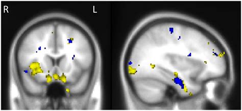Voxel Based Morphometry Results Showing Regions That Correlate With Download Scientific Diagram