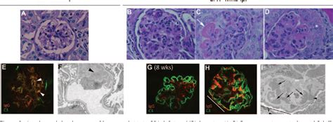 Figure 2 From Complement Factor H Deficiency Accelerates Development Of
