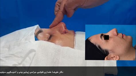 جراحی زیبایی بینی گوشتی دکتر علیرضا کیفری علمداری