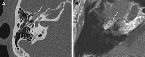 Temporal Bone Tumors Neuroimaging Clinics