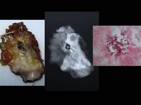 Sectioned Pathology A 3mm Serial Sections Of The Lumpectomy Specimen Download Scientific