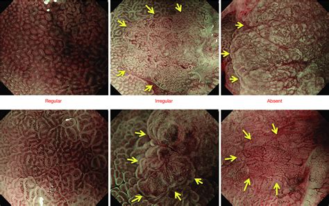 Vs Classification Using Magnifying Endoscopy With Nbi The