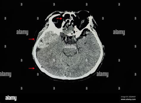 A CT Brain Scan Of A Patient With Epidural Hematoma At Right Temporal Convexity With Mass Effect