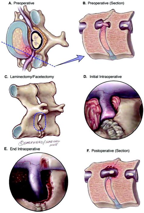 Laminectomy Decompression Facetectomy And Foraminotomy