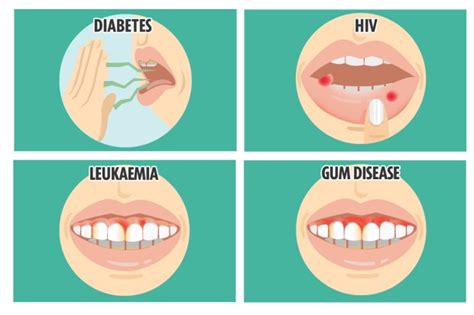 The Signs Of Serious Disease Hidden Inside Your Mouth From Cancer To Hiv And How To Check