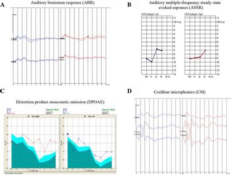 Audiologic Tests Of Subject Ii 3 Subject Ii 3 Was Diagnosed With Ansd Download Scientific