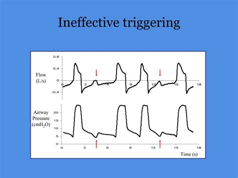 Ppt Patient Ventilator Asynchrony Powerpoint Presentation Free