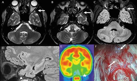 John Libbey Eurotext Epileptic Disorders Temporal Encephalocele A Rare But Treatable Cause