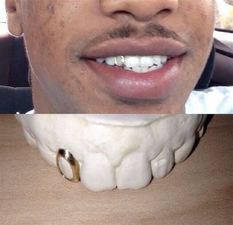 Gold Tooth Cap Molar