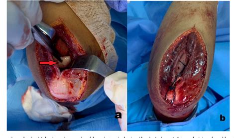 Figure 1 From Anterior Trans Olecranial Dislocation Of The Elbow In