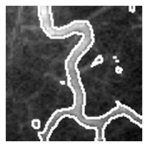 Level Set Segmentation Of The Ct Vessel By Various Initializations Download Scientific Diagram