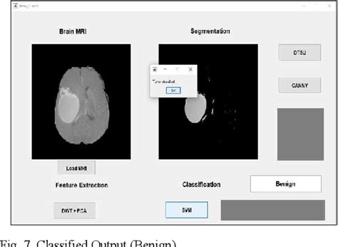 figure 7 from svm based brain tumor detection and classification system