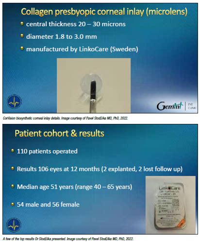 Escrs Correcting Presbyopia With A Collagen Corneal Inlay