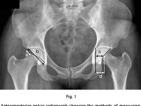 Figure 1 From Three Dimensional Ct Analysis To Determine Acetabular