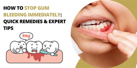 How To Stop Gum Bleeding Immediately Quick Remedies And Expert Tips