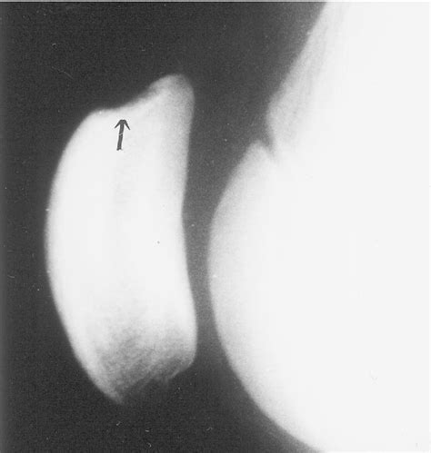 Figure 1 From A Case Of Apophysitis Of The Proximal Patella