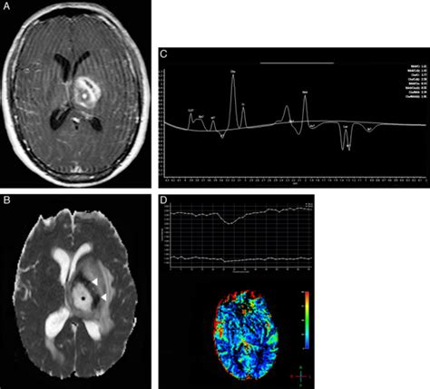 A Focal Brain Lesion In An Aids Patient Toxoplasmosis Versus