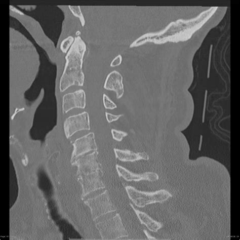Persistent Ossiculum Terminale Radiology Case Radiology Cervical Radiography