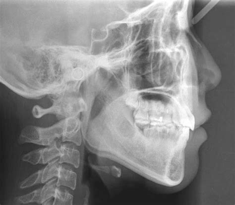 Posttreatment Lateral Cephalometric Radiograph Download Scientific