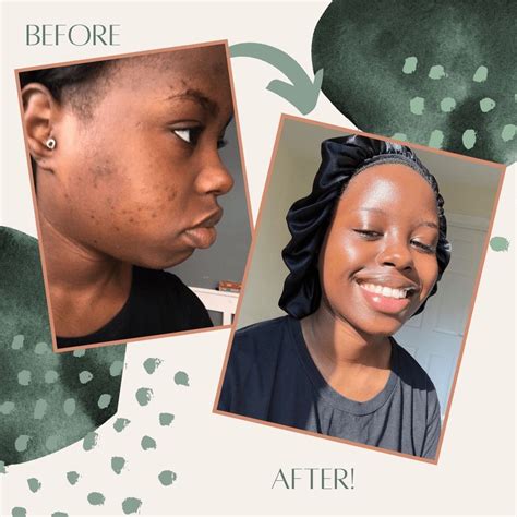 Hyperpigmentation Journey Tips For Reducing Dark Spots