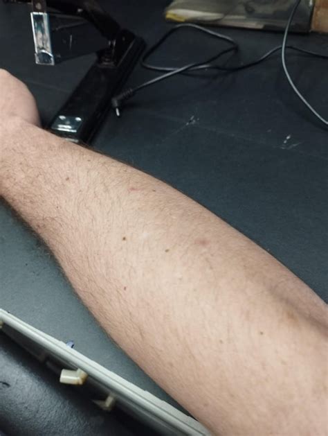 Is This Folliculitis Im Full In The Arms And Forearms Chests And