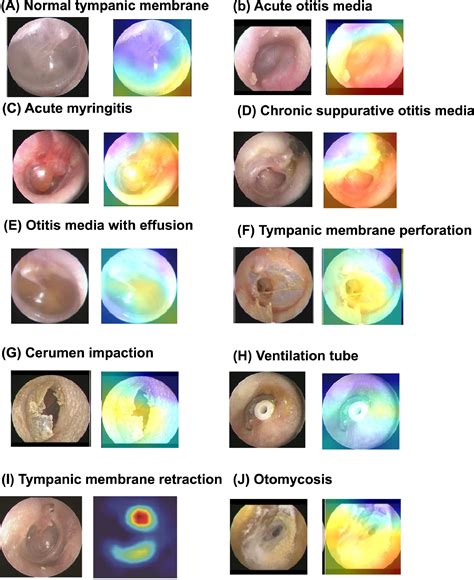 Acute Otitis Media Tympanic Membrane