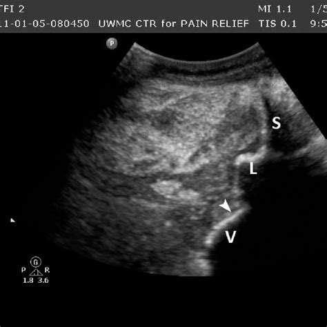 Pdf Ultrasound Guided Lumbar Transforaminal Injections