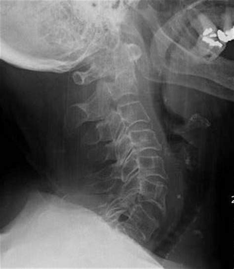 Odontoid Fracture Spine Orthobullets